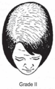 Ludwig Female Hair Loss Scale: Stages & Treatment Options | Hair Growth ...